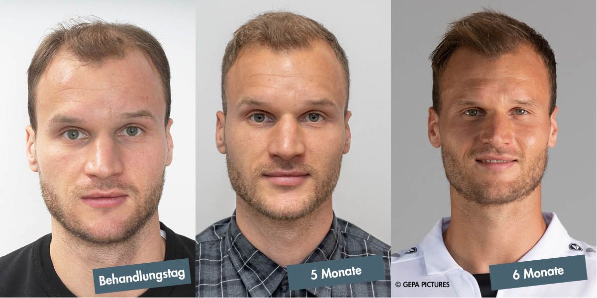 Haartransplantation von Matthias Maak | Moser Medical Wien